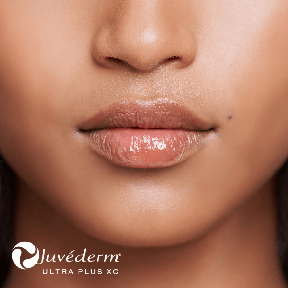 JUVÉDERM® Ultra Plus XC Signature Medical Spa